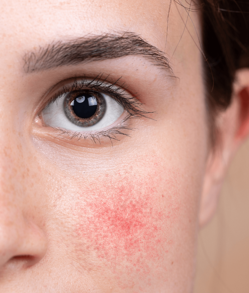 IPL Treatment For Sun Damage | Fiore Aesthetics