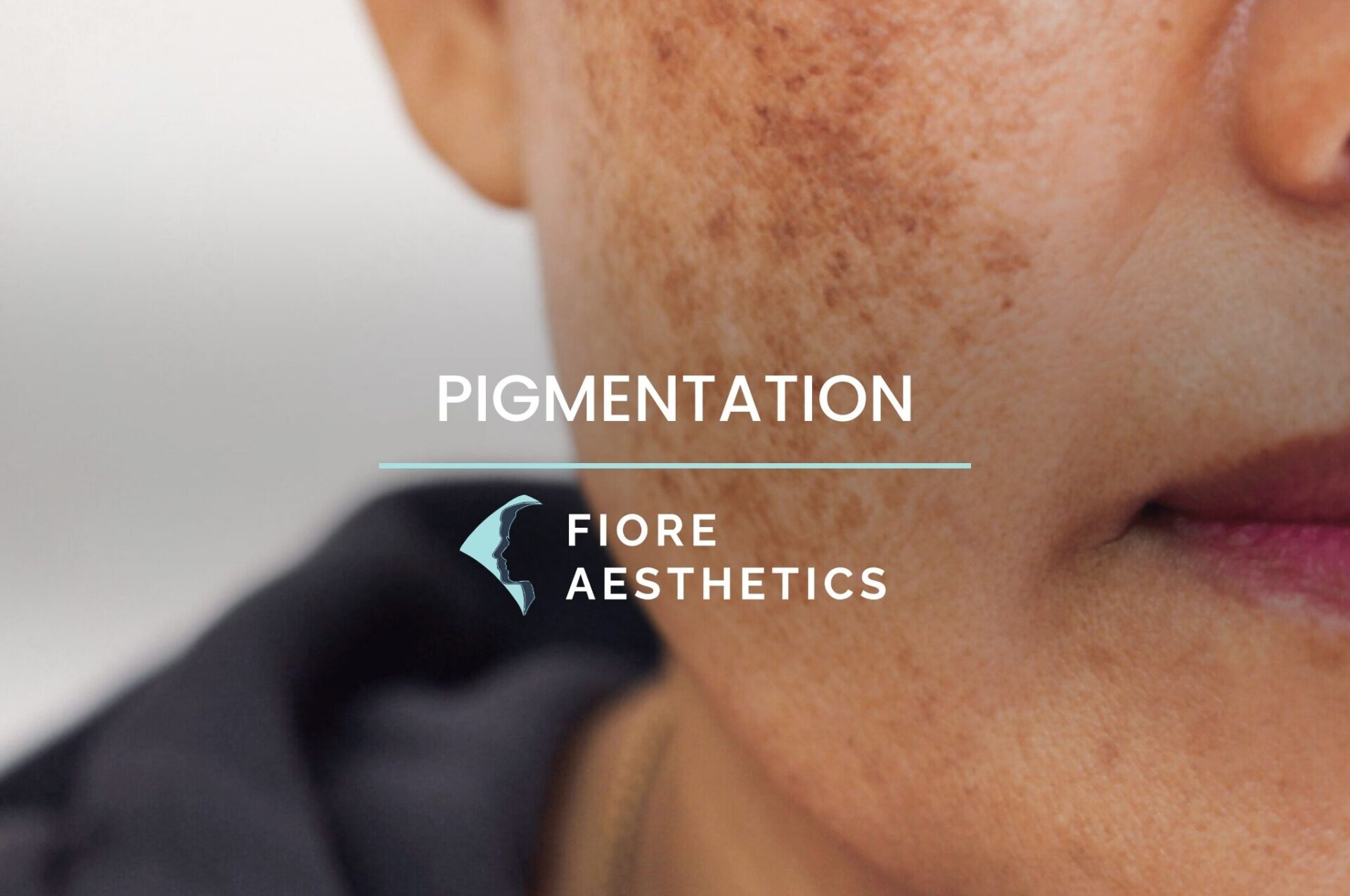 Pigmentation: Causes, Symptoms & Treatments | Fiore Aesthetics