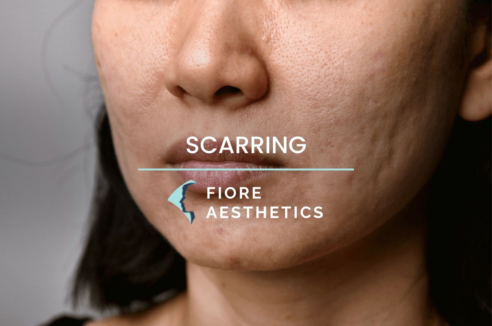 Scarring: Causes, Symptoms & Treatments | Fiore Aesthetics